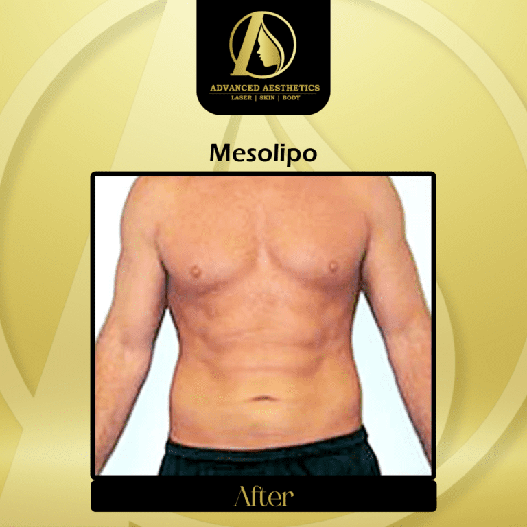 Mesolipo - Advanced Aesthetic Specialist